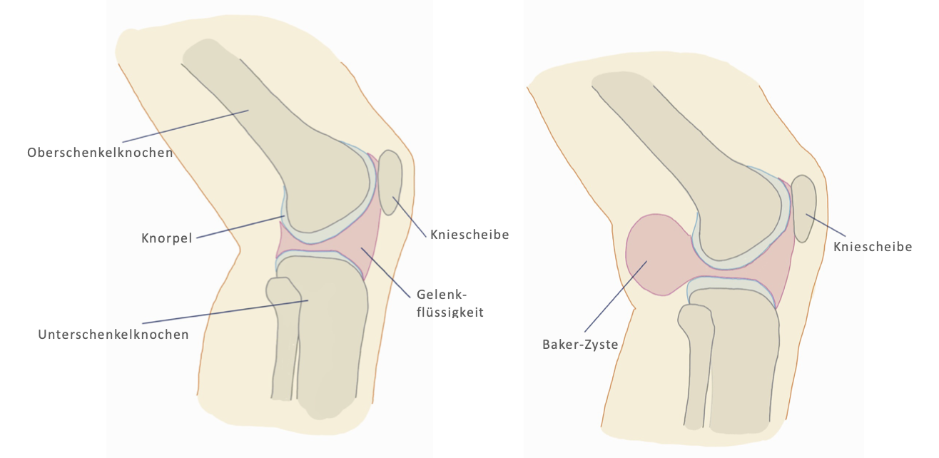 Baker Zyste – Physiotherapie & Osteopathie Beger | Leipzig Böhlitz-Ehrenberg